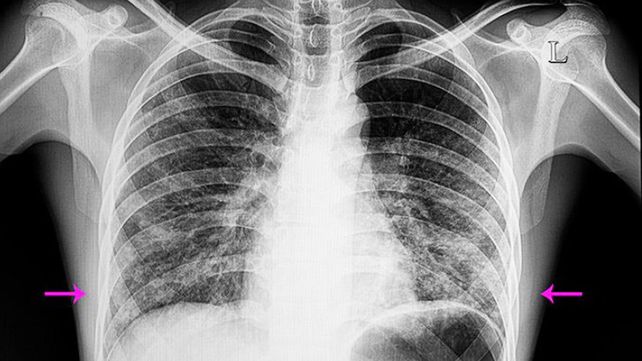 Neumonía bilateral en Tucumán: qué se sabe de la infección