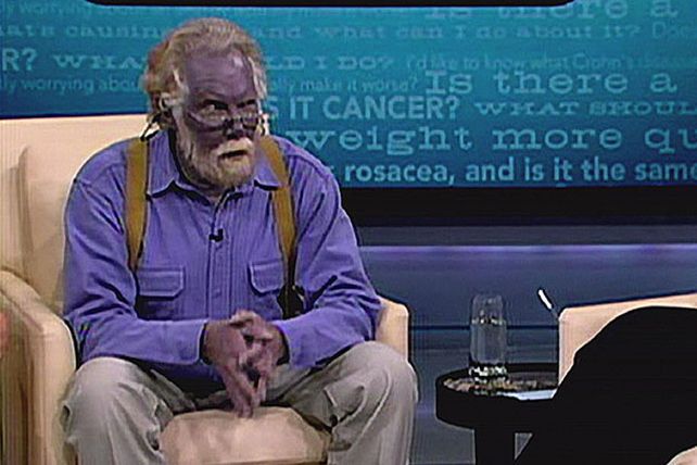 Murió Paul Karason, el hombre de piel azul