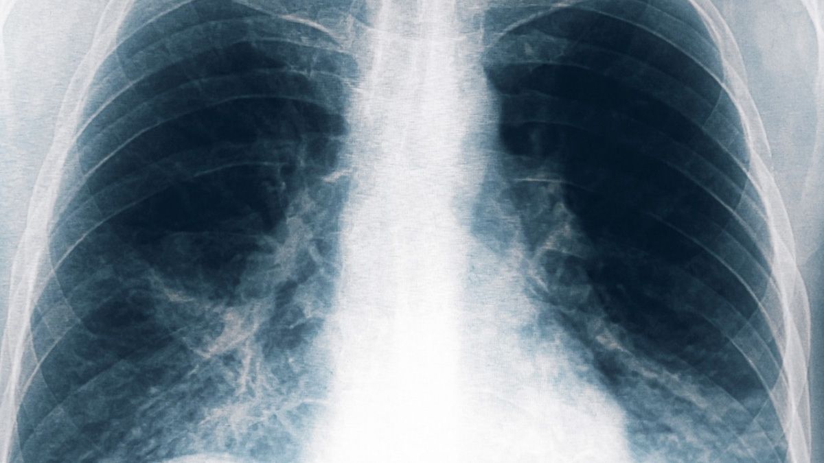 Neumonía bilateral por legionella: nuevos casos en Tucumán