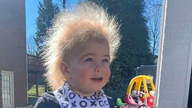 Síndrome del cabello impeinable: rara anomalía diagnosticada