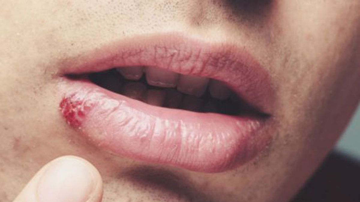 Herpes: la infección que sufren 3.700 millones de personas (y quizás tú)