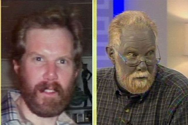 Murió Paul Karason, el hombre de piel azul