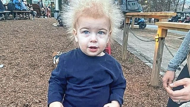Síndrome del cabello impeinable: rara anomalía diagnosticada