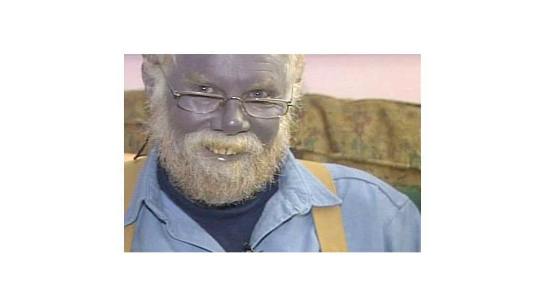 Murió Paul Karason, el hombre de piel azul
