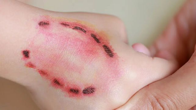 Duelen Las Mordeduras De Perro