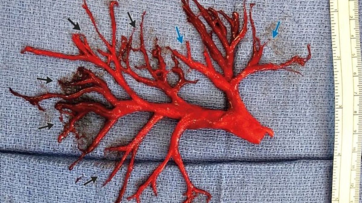 El increíble coágulo de sangre que escupió un paciente con la forma de ...