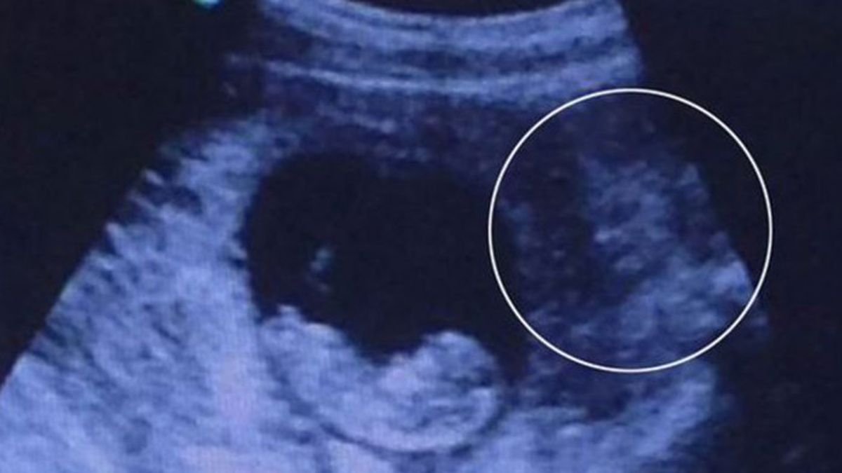 Una ecografía se viralizó ante la supuesta aparición de un demonio ...