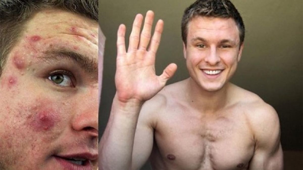 Sufría de un severo acné y reveló qué lo hizo desaparecer