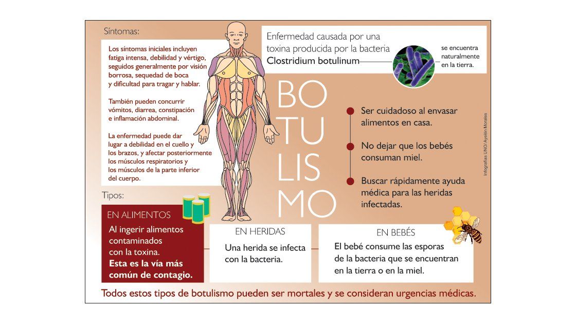 Botulismo: la importancia de identificar los primeros síntomas